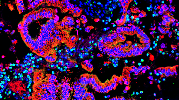 Wie das Immunsystem Bauchspeicheldrüsenkrebs beeinflusst: UMG ...